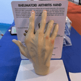 Osteoarthritis Hand Model, Model of Hand Pathology - Walmart.com