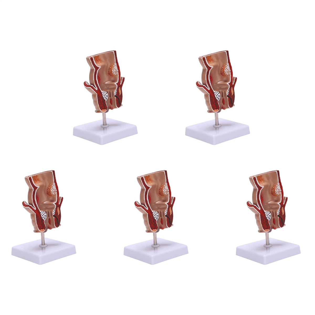 5X Anatomy Model Human Rectal Lesion Model Fistula Fistula Fissure ...