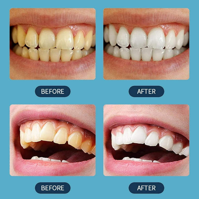 Baking Soda Toothpaste Before And After Eelhoe Baking Soda Whitening