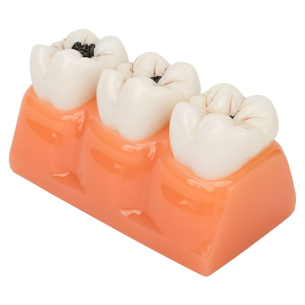 Times Caries Model,Resin Dental Caries Teeth Caries Model Tooth Decay ...