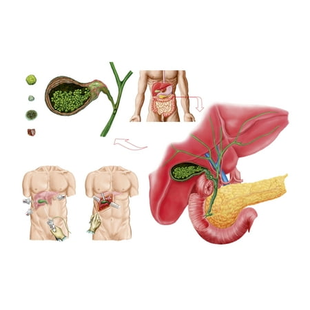 Medical ilustration showing gallstones in the gallbladder and the ...