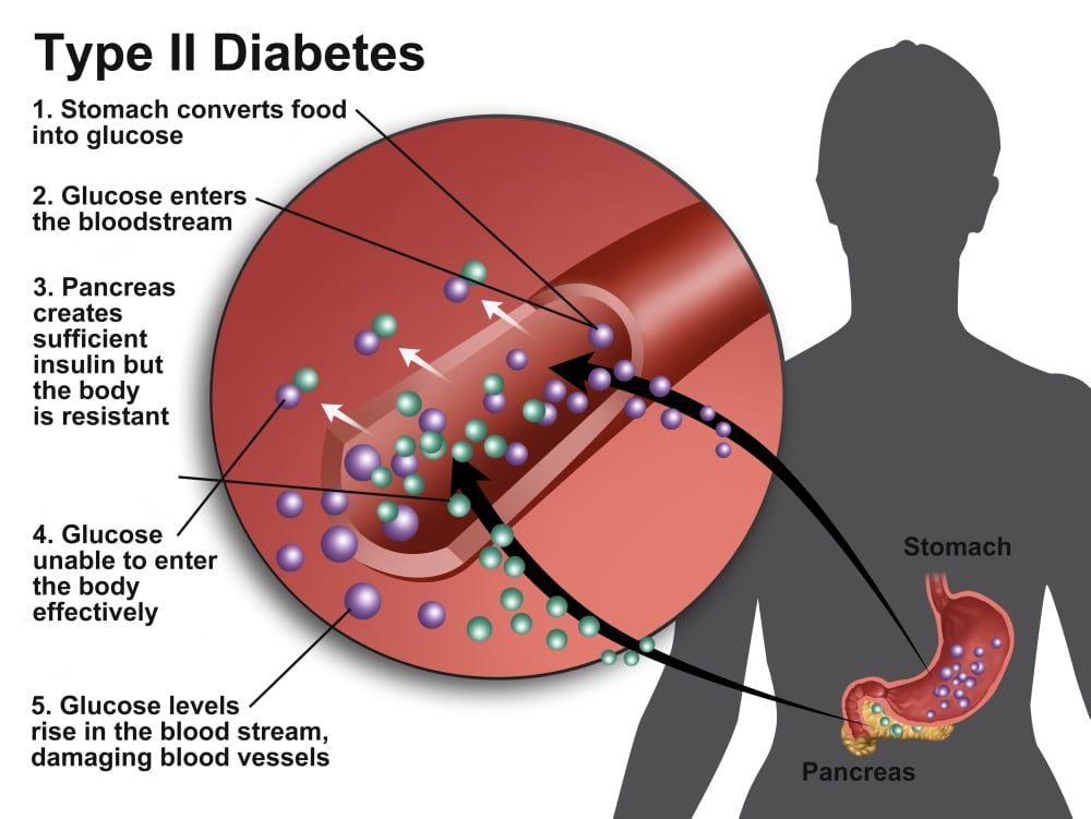 Type 2 Diabetes Poster Print by Gwen ShockeyScience Source - Walmart ...