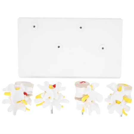 4‑Stage Human Spine Model Lumbar Vertebrae Spine Normal Pathological ...