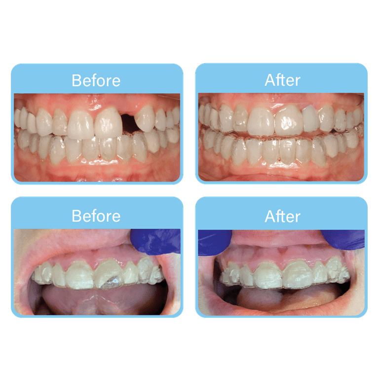 Retainer For Missing Teeth