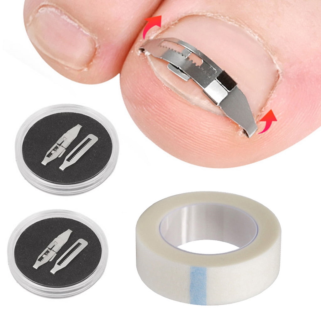 Carbon steel Ingrown Toenail Pedicure Tool Straightening Correction ...
