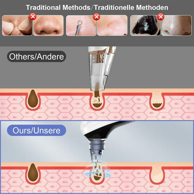 Blackhead Removal Diagram