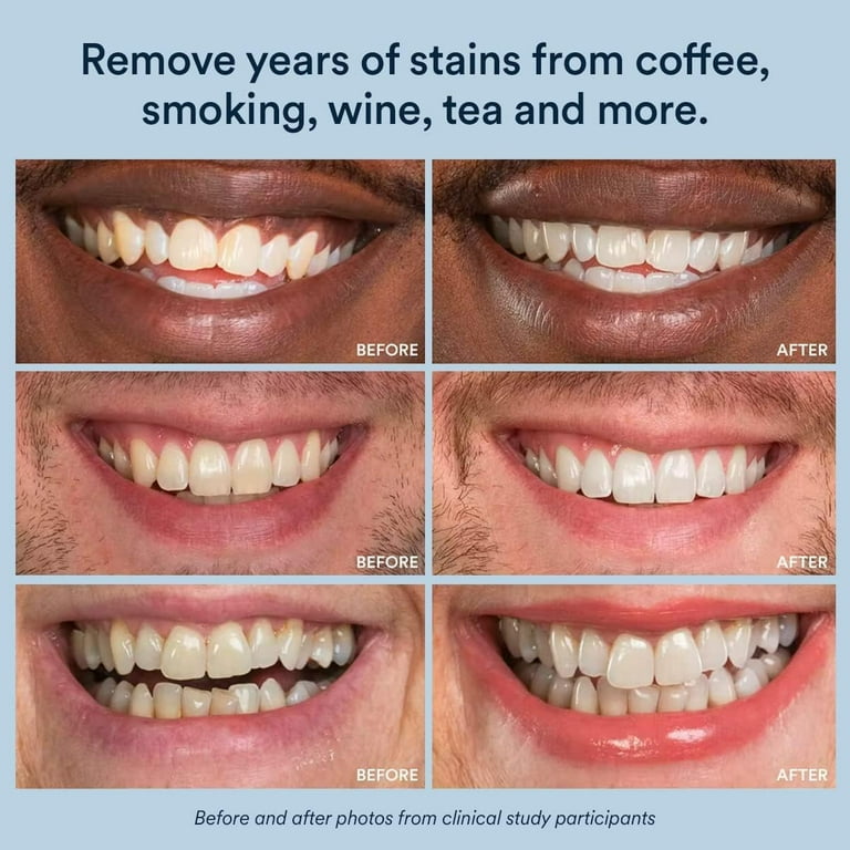 Before And After Teeth Whitening With Peroxide