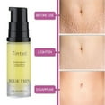 Removal Acne Scar Stretch Marks Cream Scar Striae Gravidarum Treatment
