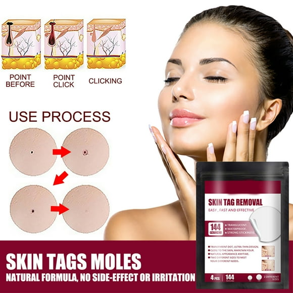 Skin Tag Removal Cream
