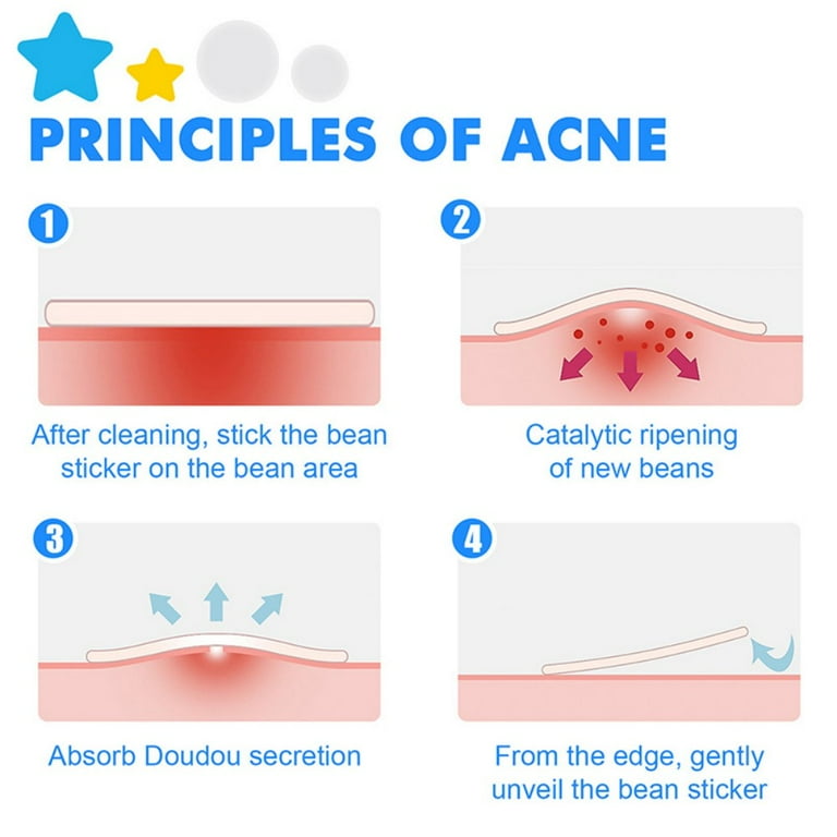 Nodular Acne Diagram