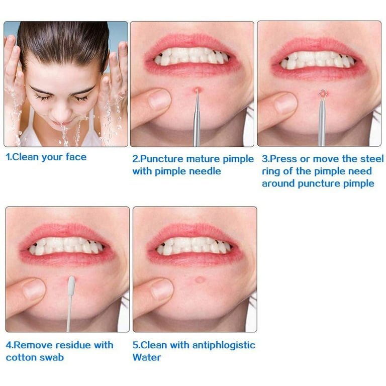 Whitehead Pimple On Lip