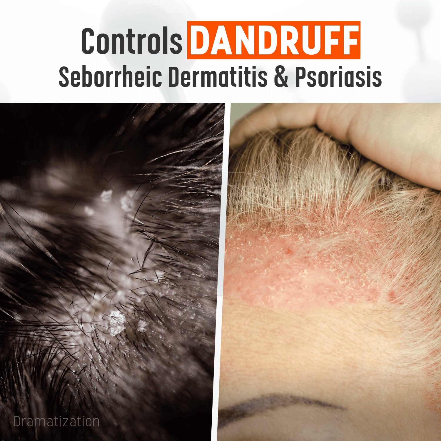 Seborrheic Dermatitis Vs Dandruff | ubicaciondepersonas.cdmx.gob.mx Seborrheic Dermatitis Vs Dandruff | ubicaciondepersonas.cdmx.gob.mx