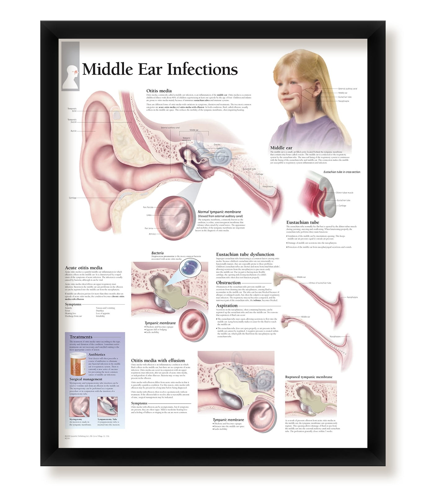 Middle Ear Infections Framed Medical Educational Informational Poster ...