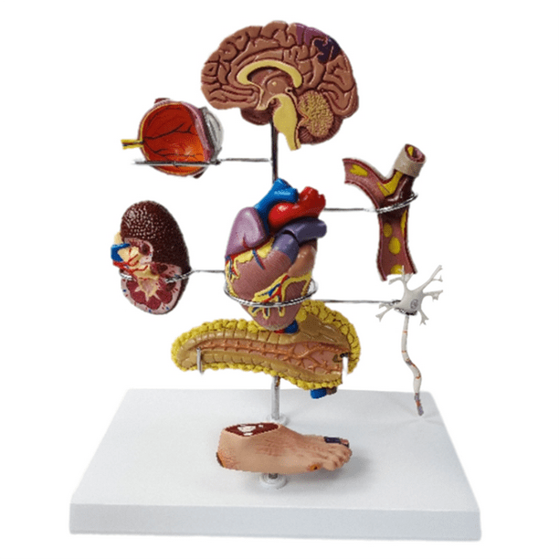 Conjunto de Modelos de Diabetes Tipo Ii, para Educación Sobre Anatomía ...
