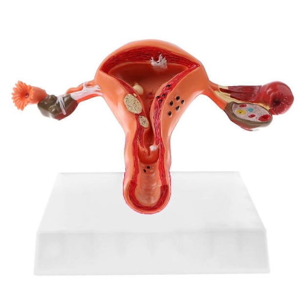 Medical props model Free postage Pathological Uterus Ovary Anatomical ...