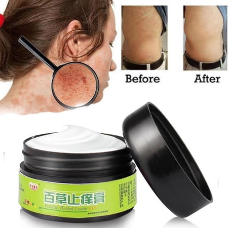 Archer Efficace Herbal Pommade Dermatite Psoriasis Eczéma Crème Anti ...