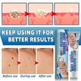 Jaysuing Gram Wart Cream Repair Filiform Wart Face Neck Armpit Fleshy ...