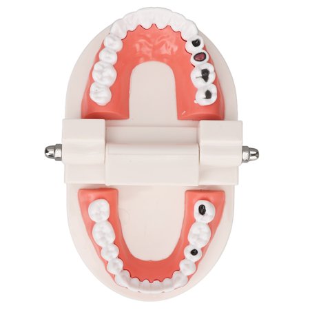 Teeth Model, Caries Tooth Model Clear Structure Simulation Lightweight ...