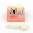 Dental Implant Teeth Model Disassemble for Dentist Doctor-patient ...