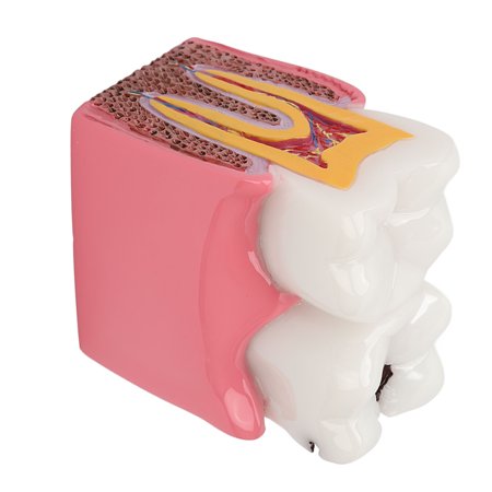 Dental Caries Model,Dental Caries Model Tooth Dental Anatomy Teaching ...