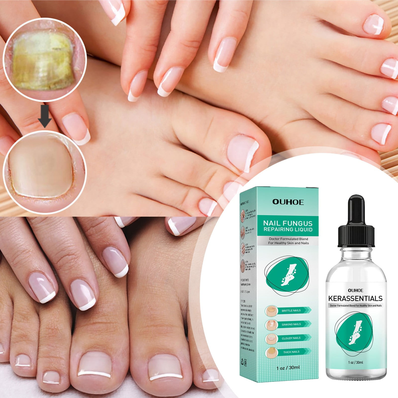 30ML 1FL OZ Toenail Fix Liquid To Fix Nails, Rotten Toenails, Mild ...