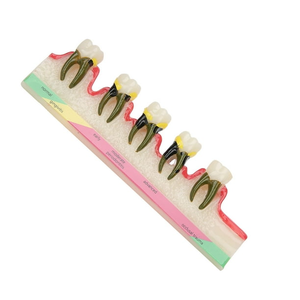 Dental Disease Model,Dental Periodontal Disease Model Teeth Model ...