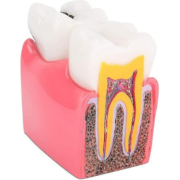 Tooth Decay Comparison Model Tooth Decay Section Display Pulp-opened ...
