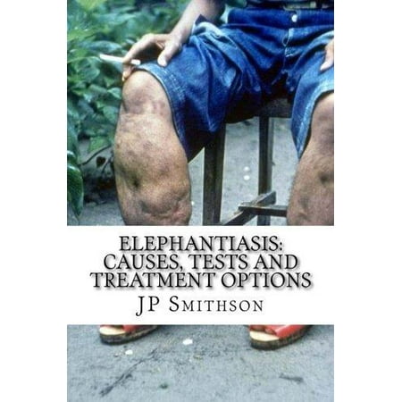 Elephantiasis: Causes, Tests and Treatment Options | Walmart Canada