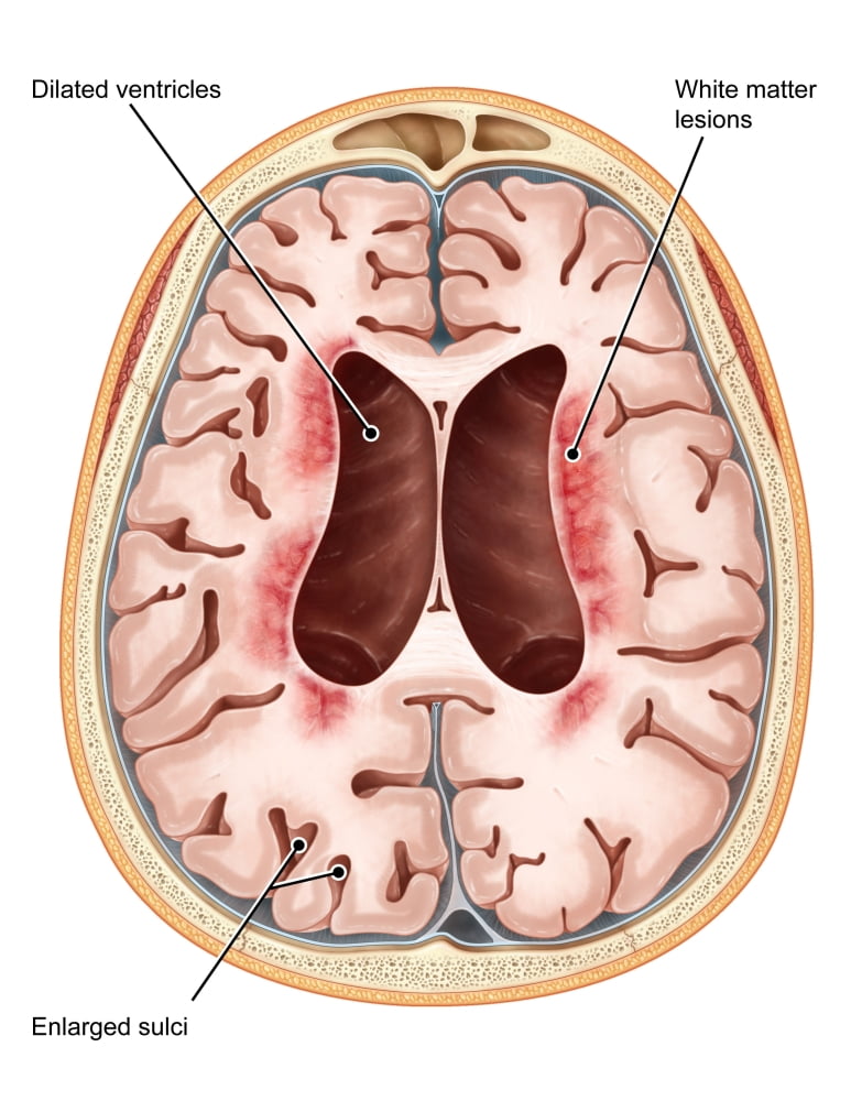 Neuronal Ceroid Lipofuscinosis Poster Print By Evan Oto Science Source
