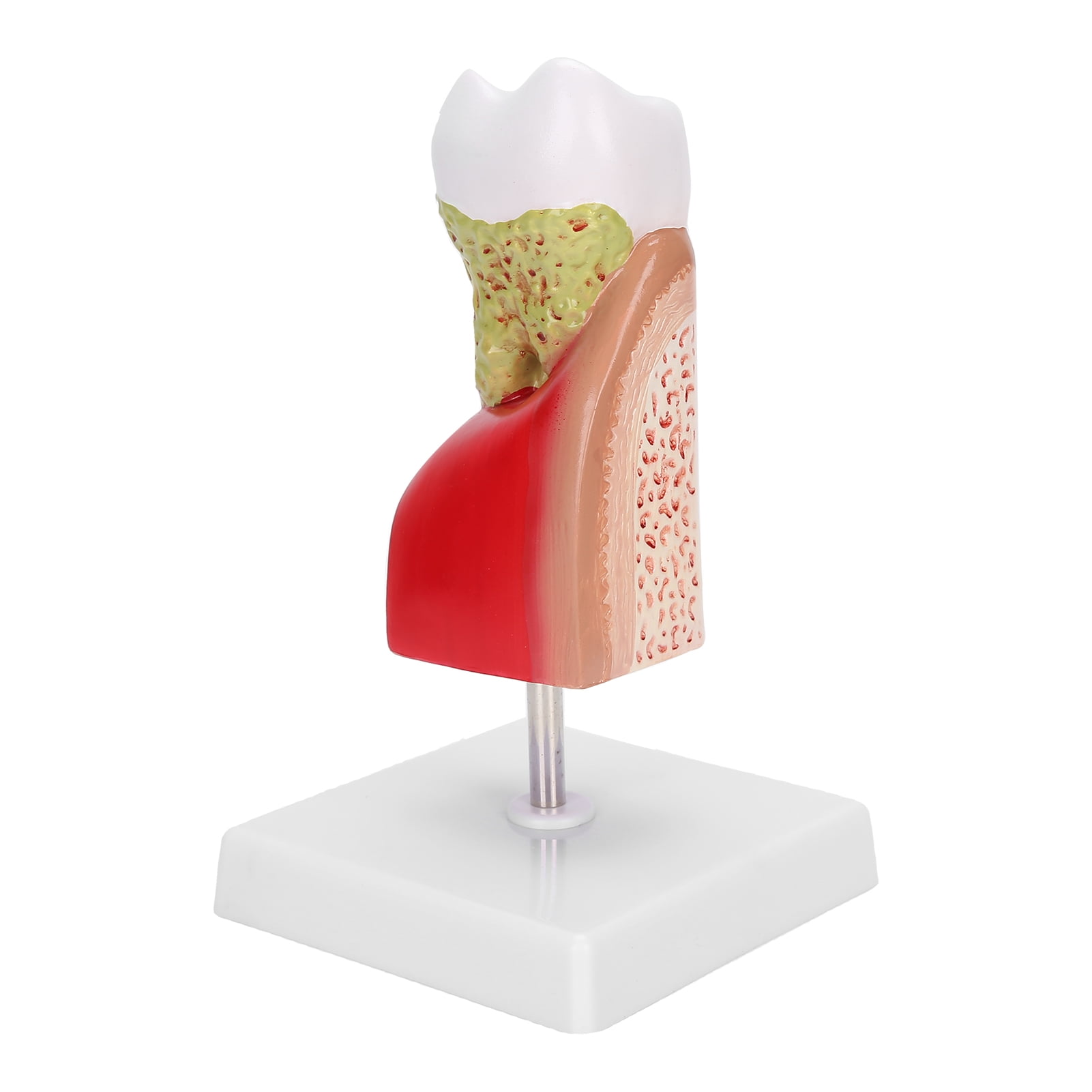 Standard Teeth, Caries Tooth Model, Enhance Patient'S Awareness Caries ...