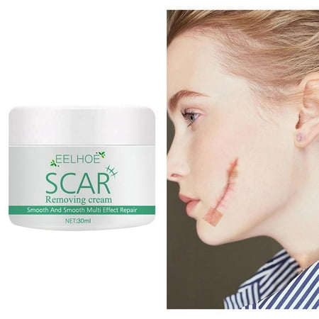 Scar Removal Cream Stretch Mark scar cream Cream for face Dispel Acne ...