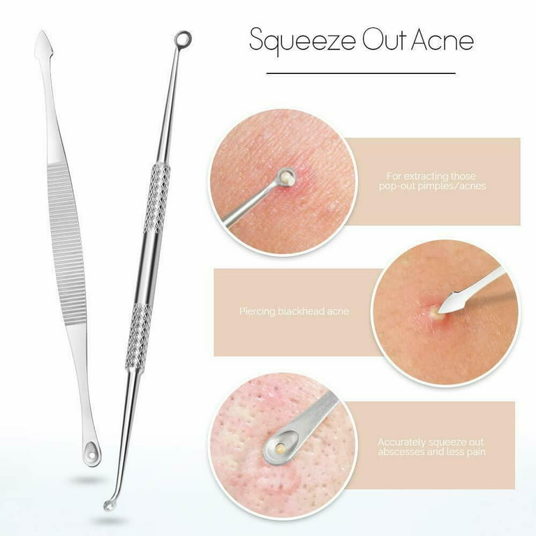 Squeeze Blackhead