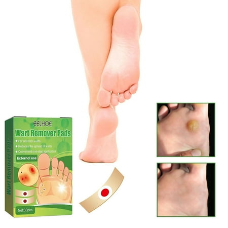 Wart Remover, Corn Removal Plaster With Hole, Corn Removal Relief Corn ...