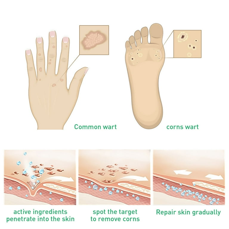 Plantar Warts Diagram