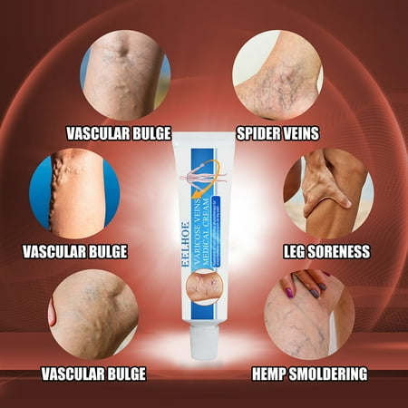 20g Varicose Cream Varicose Veins Cream Phlebitis Angiitis Removal Legs ...
