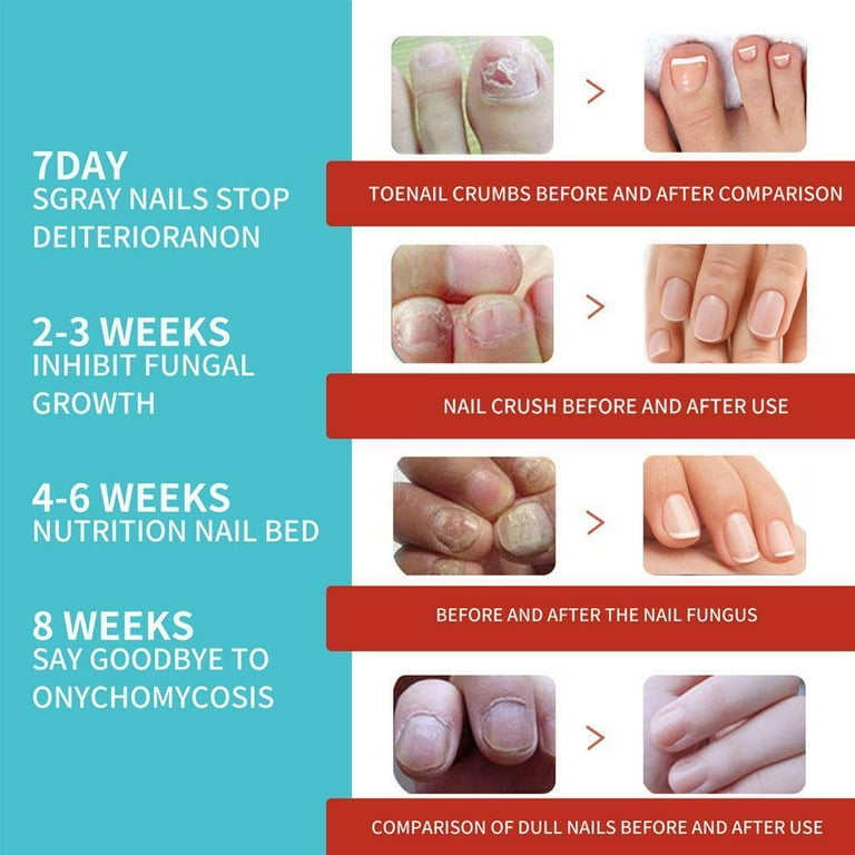 Toe Nail Replacement