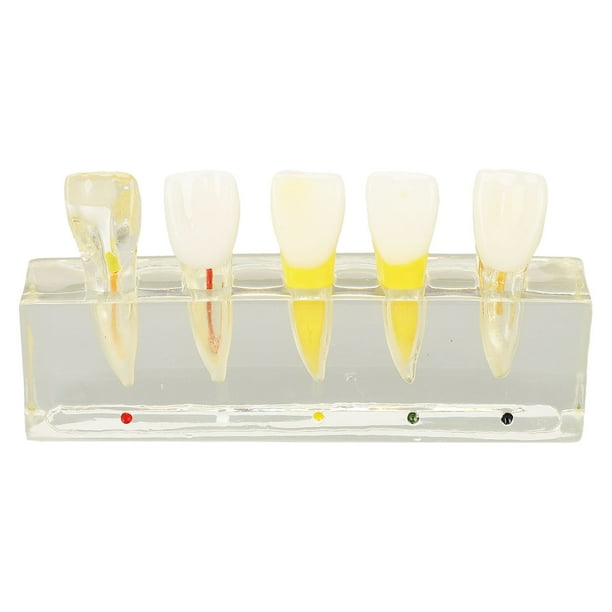 Dental Endodontic Model,Dental Pulp Cavity Model Dental Pulp Model ...