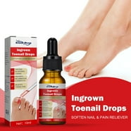 Ingrown Toenail Pain Reliever, 1 kit, (w/ Gel, 12 retainer rings & 12 ...