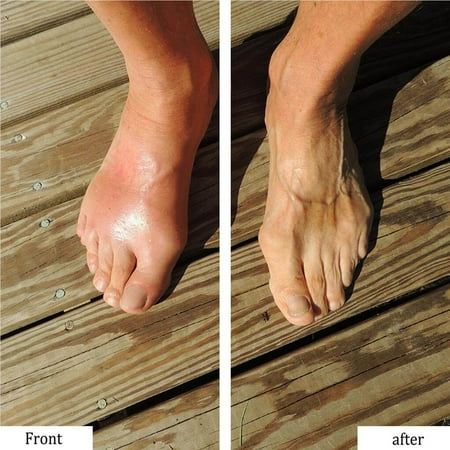 Ginger Foot Pad Anti-Swelling Foot Pad and Body Cleansing Food Pads ...