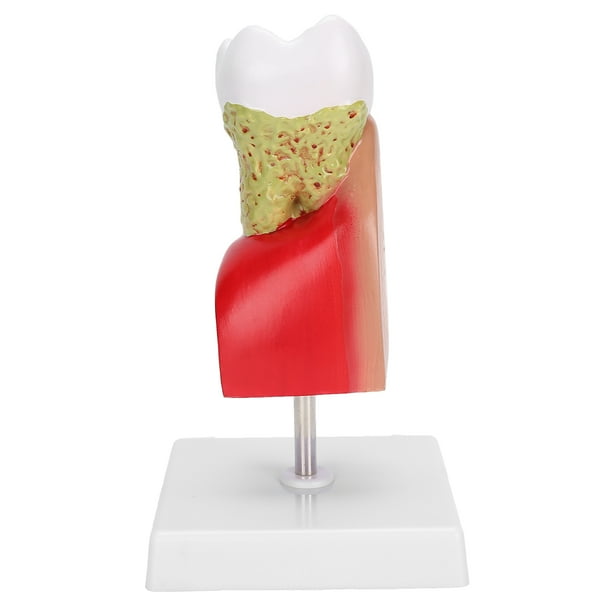 Caries Tooth Model,Dental Caries Tooth Model Dental Teeth Model Tooth ...