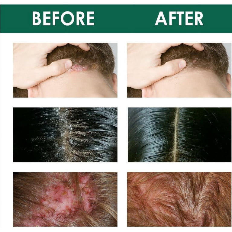 Mild Scalp Folliculitis