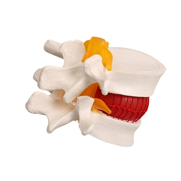 Lumbar Disc Herniation Model Lumbar Lumbar Disc Learning Spine Model ...