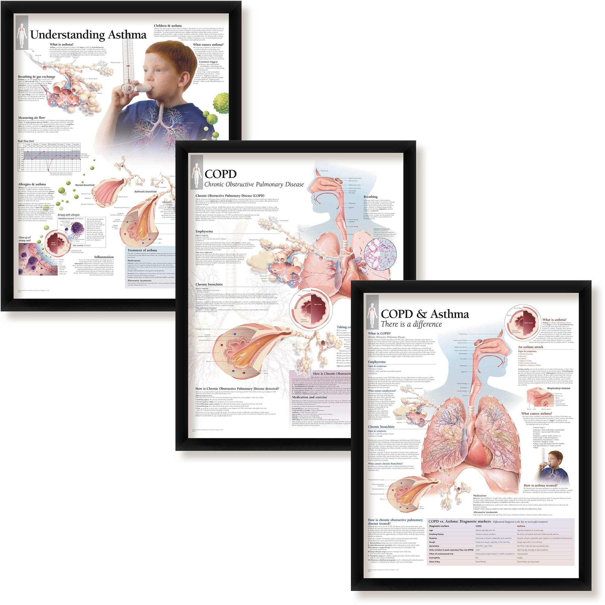 Set of 3 Framed Medical Posters Understanding Asthma, COPD, and COPD ...