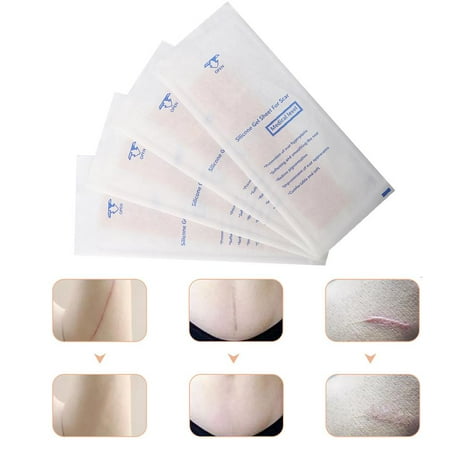 Sonew Scar Pad,ALIVER Self-Adhesive Silicone Scar Sheet Caesarean ...