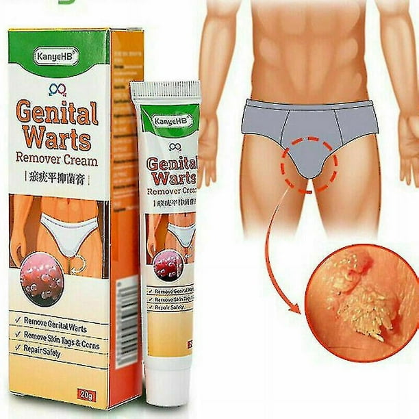 1Pcs 20g Herpe genital removedor de verrugas ungüento etiqueta de piel Mole acuminatum ...
