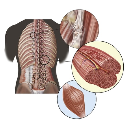 Detail of deep back muscles with a close-up of sprain, strain and spasm ...
