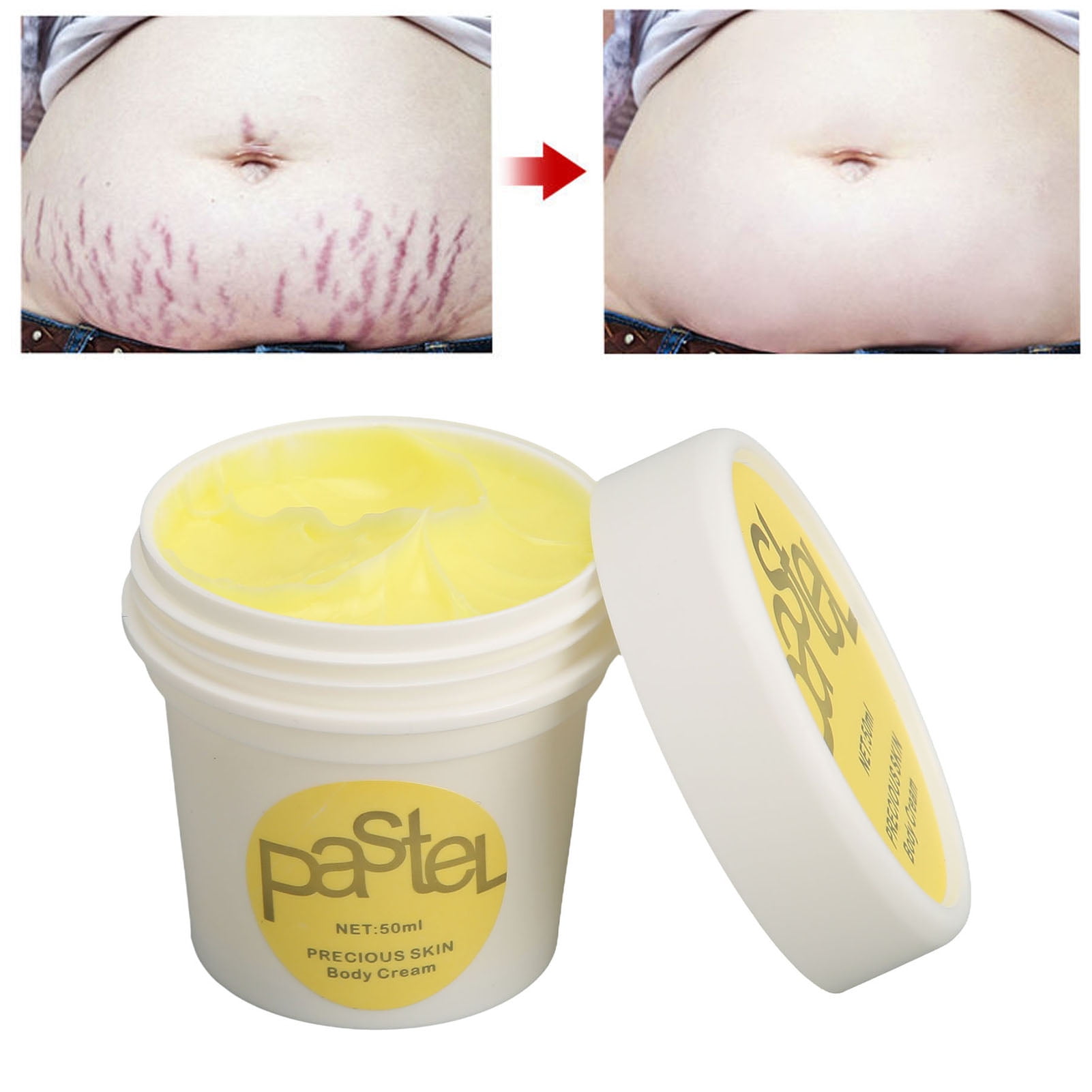 Crema Para El Tratamiento De Estrías, Crema Hidratante Refrescante ...