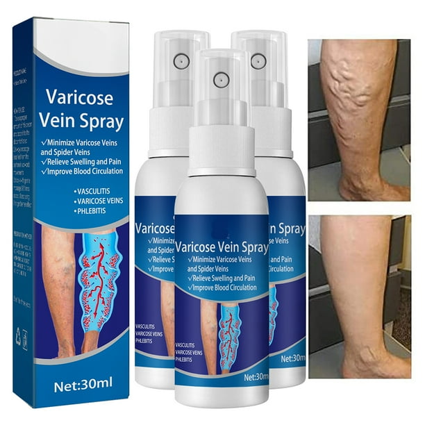 Spray para venas varicosas, 30 ml, spray natural para la eliminación de ...