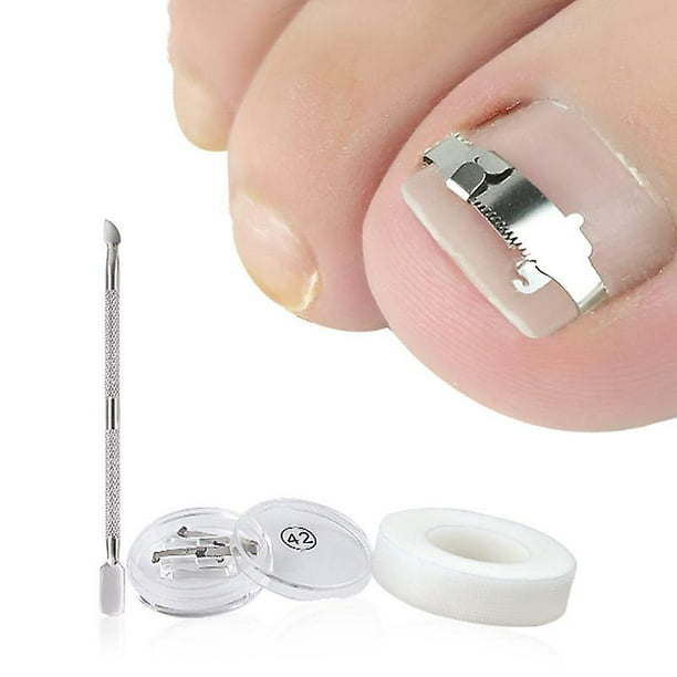 Ingrown Toenail Tool, Ingrown Toenail Correction Buckle & Toenail ...