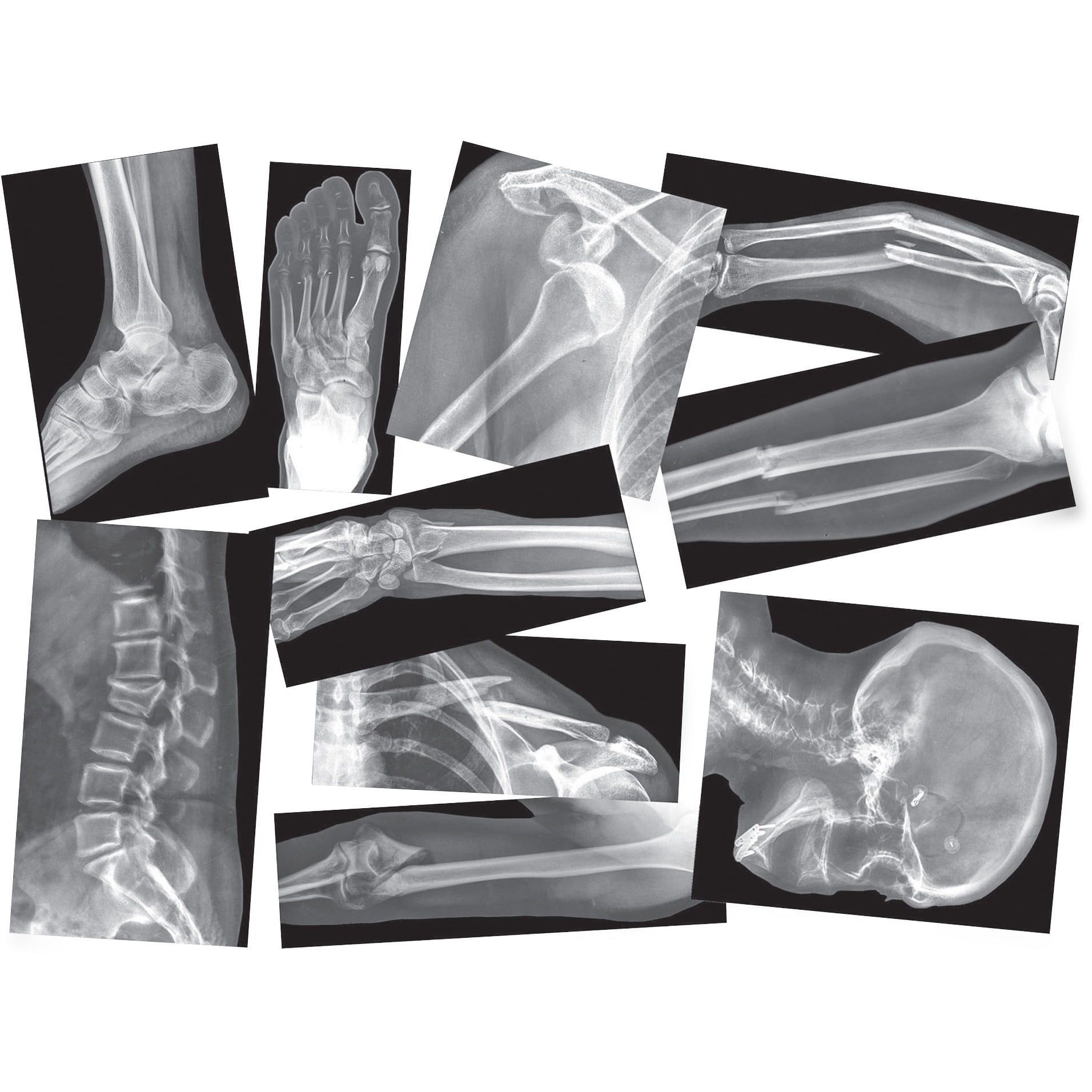 Roylco, RYLR5914, Broken Bones X-rays Set, 15 / Box - Walmart.com
